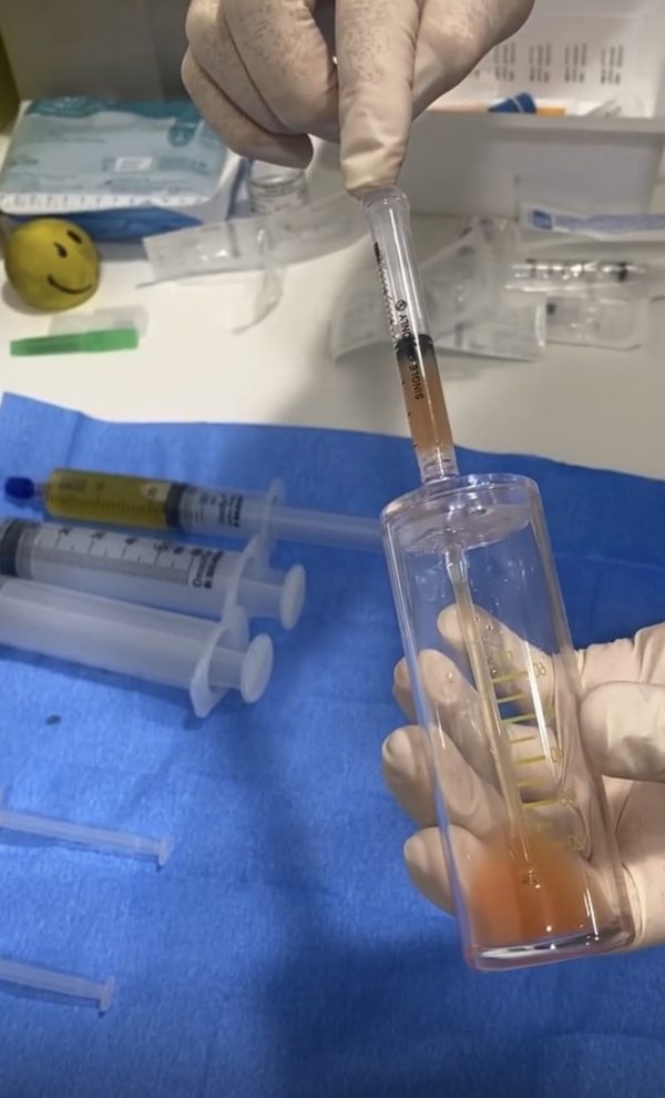 Emcyte PRP (Platelet Rich Plasma) Treatment - Natural Looks Cosmetic ...