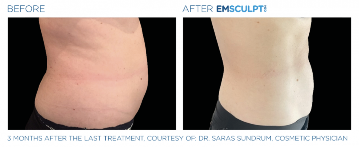 Emsculpt Neo | Less Fat More Muscle - Natural Looks Cosmetic Medicine