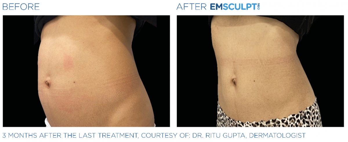 Emsculpt Neo | Less Fat More Muscle - Natural Looks Cosmetic Medicine