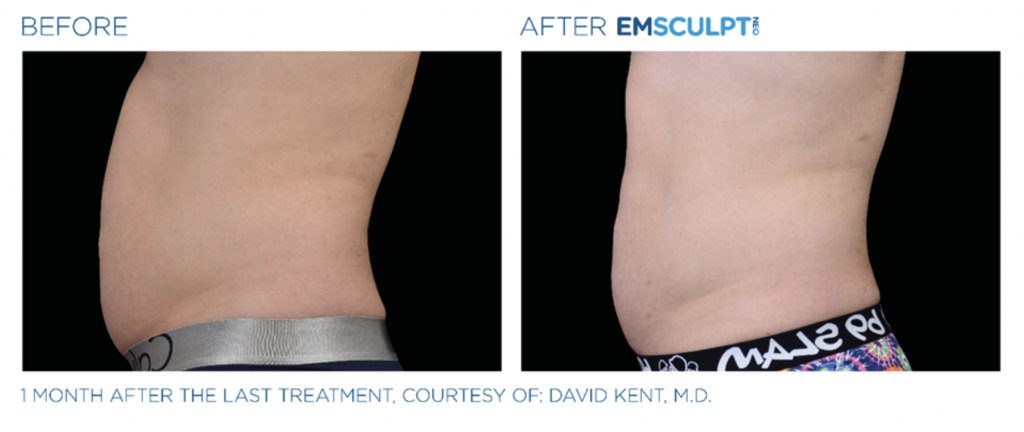 Emsculpt Neo | Less Fat More Muscle - Natural Looks Cosmetic Medicine